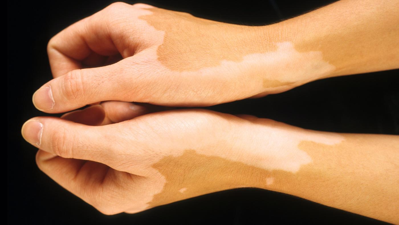 What Are Types Of Skin Discoloration Diseases