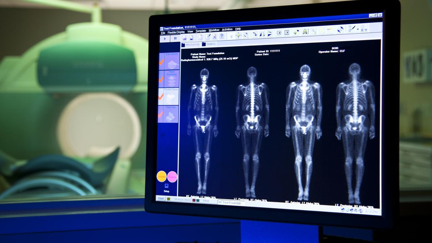 What Do Dark Spots on a Bone Scan Mean?