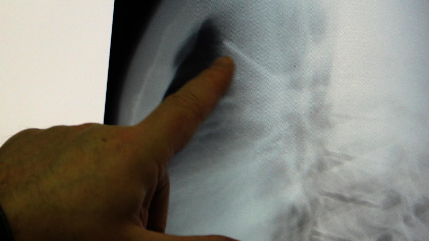 What Is a Corticated Bone?