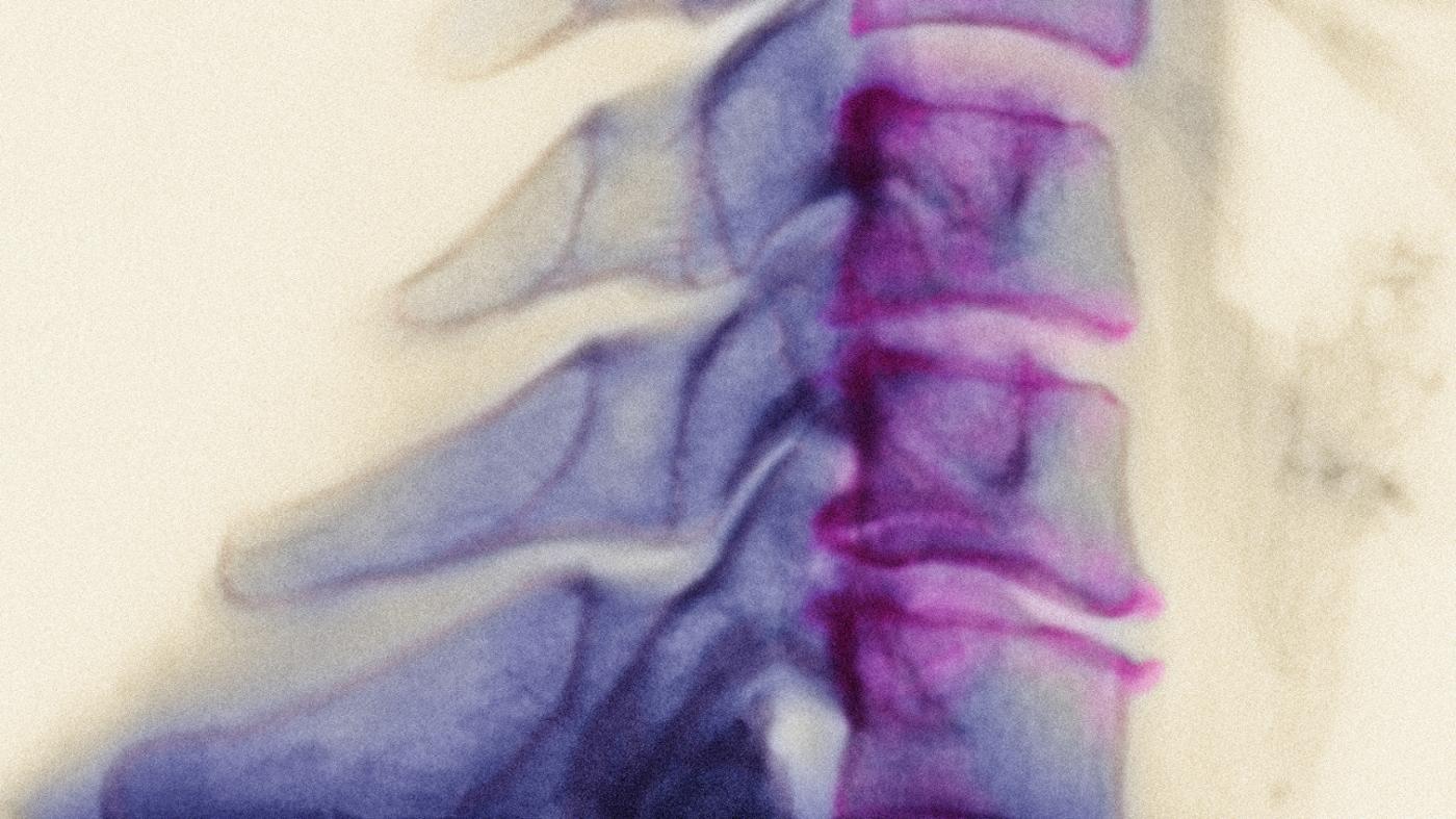 What Is Osteophytic Lipping?
