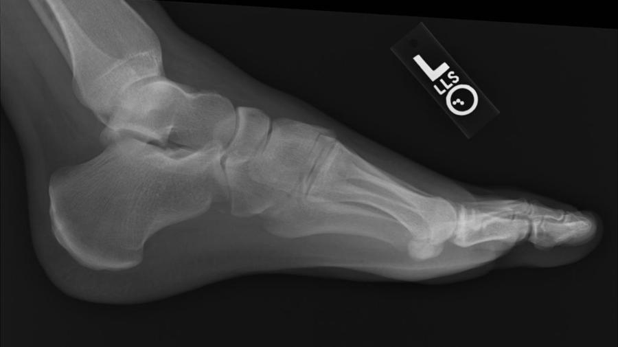 Do Africans Have an Extra Bone in Their Foot?