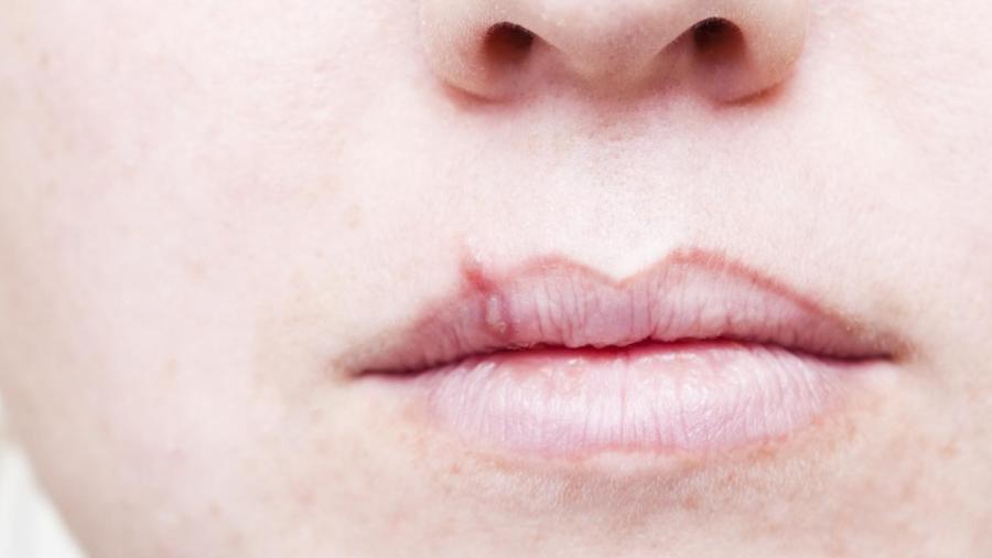 How Long Do Cold Sores Last When Using Abreva?